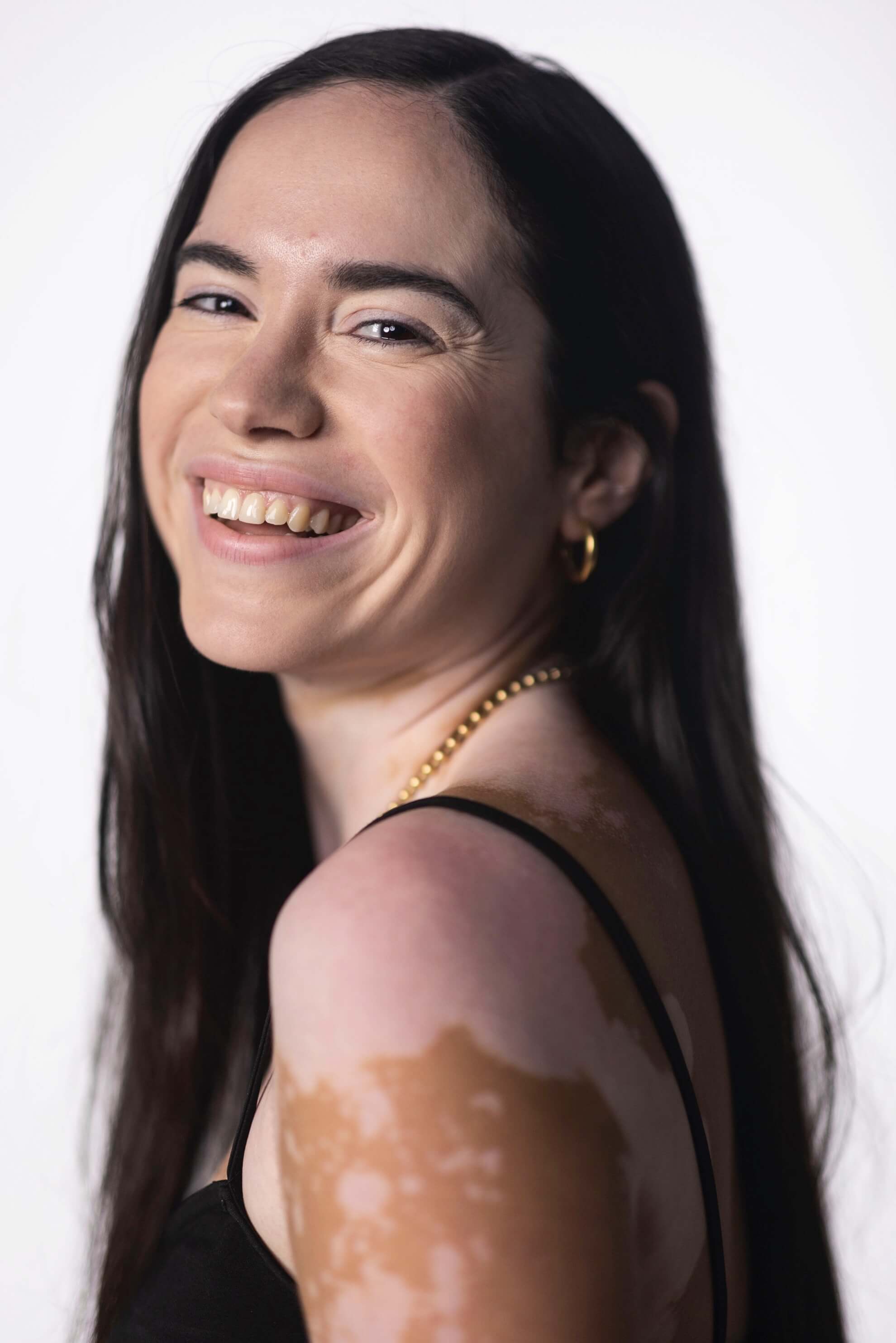 Vitiligo en Puerto Rico: cinco perfiles de puertorriqueños que viven ...