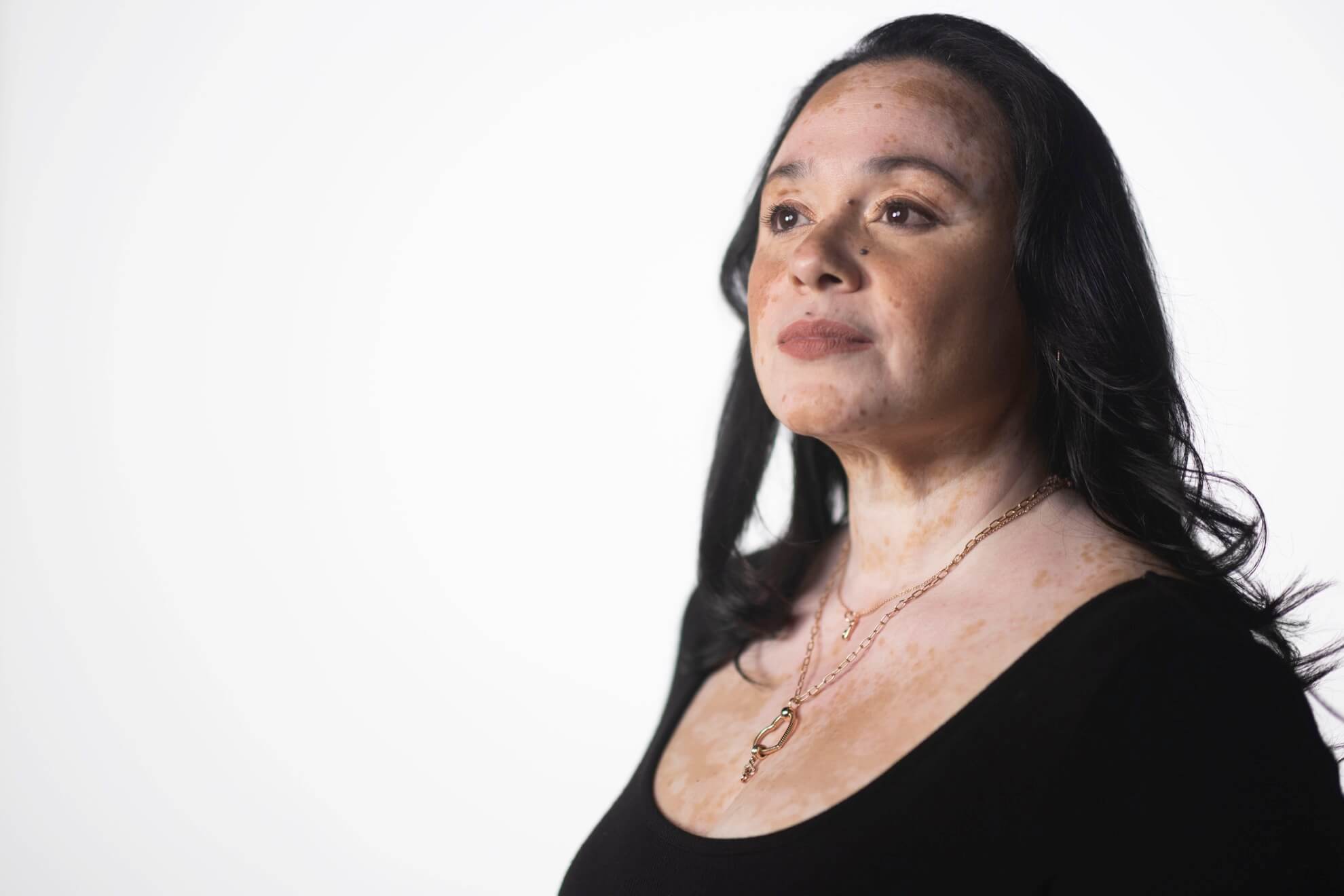 Vitiligo en Puerto Rico: cinco perfiles de puertorriqueños que viven ...