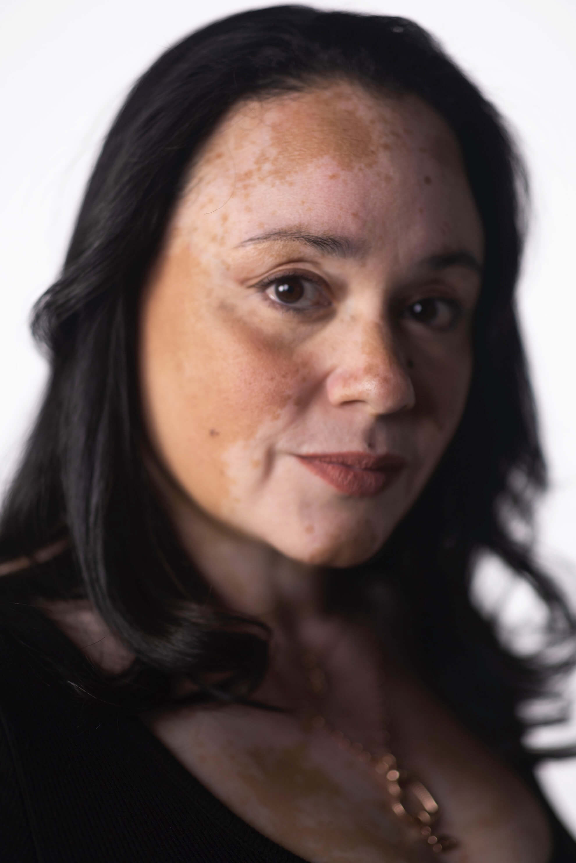 Vitiligo en Puerto Rico: cinco perfiles de puertorriqueños que viven ...