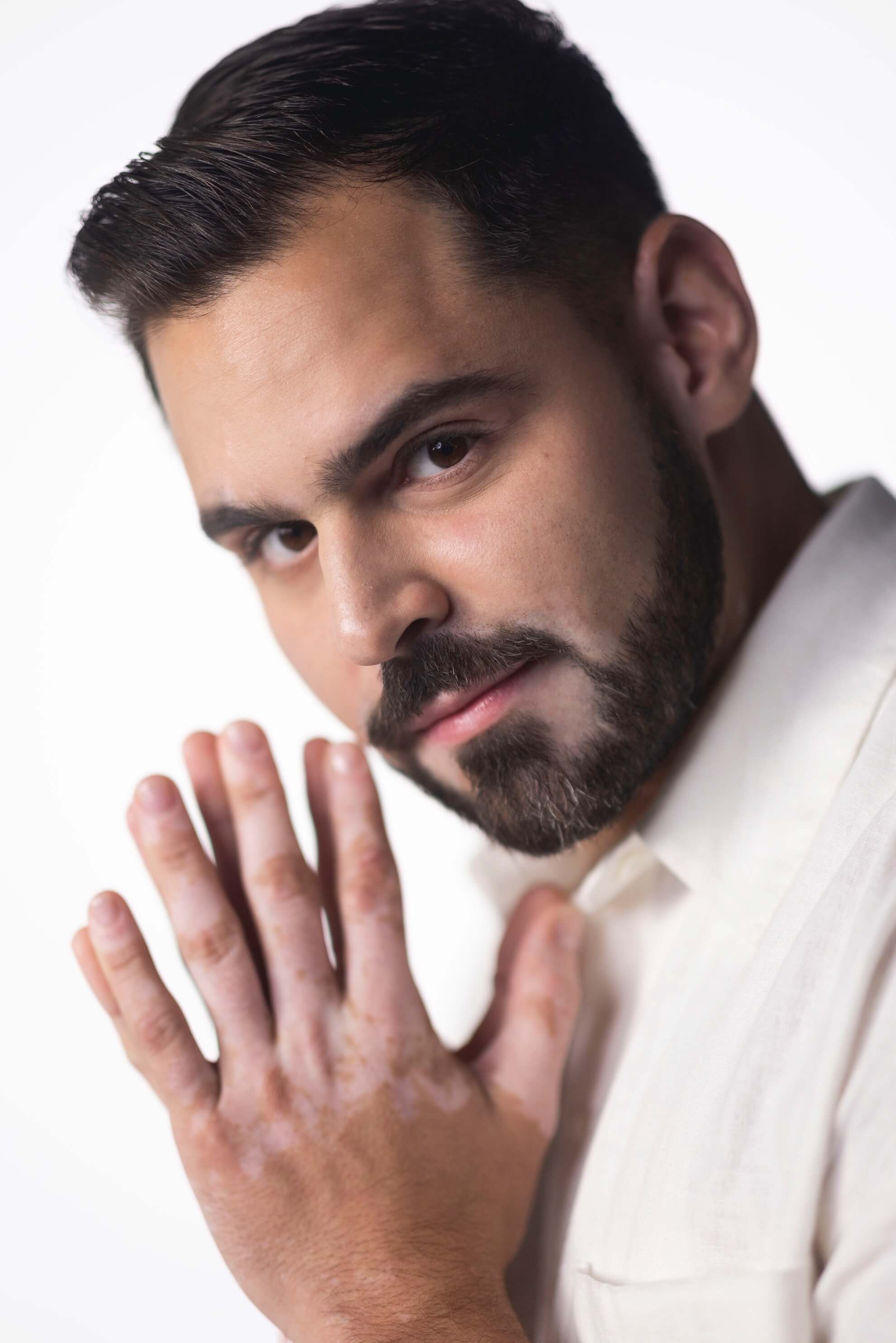 Vitiligo en Puerto Rico: cinco perfiles de puertorriqueños que viven ...