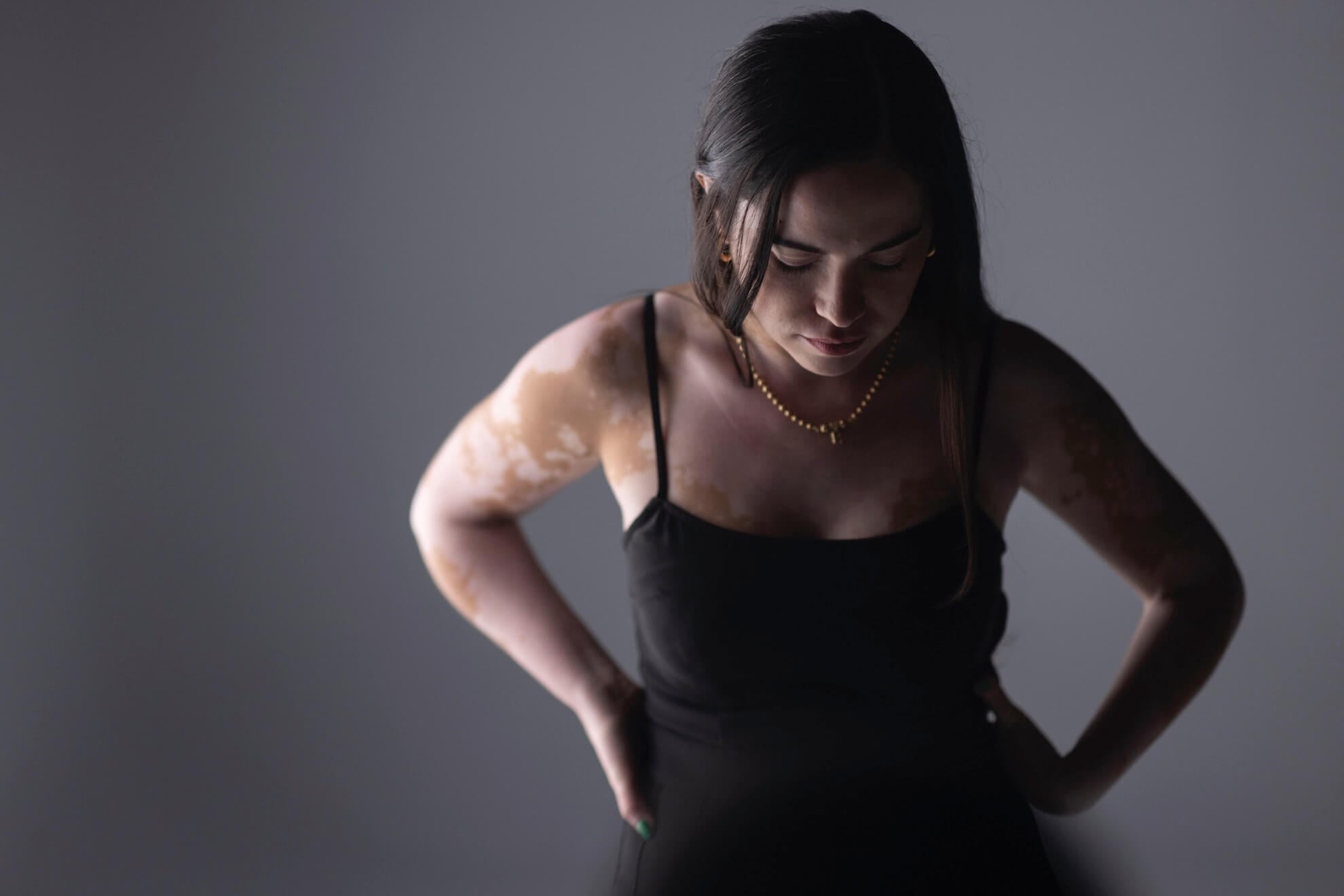 Vitiligo en Puerto Rico: cinco perfiles de puertorriqueños que viven ...